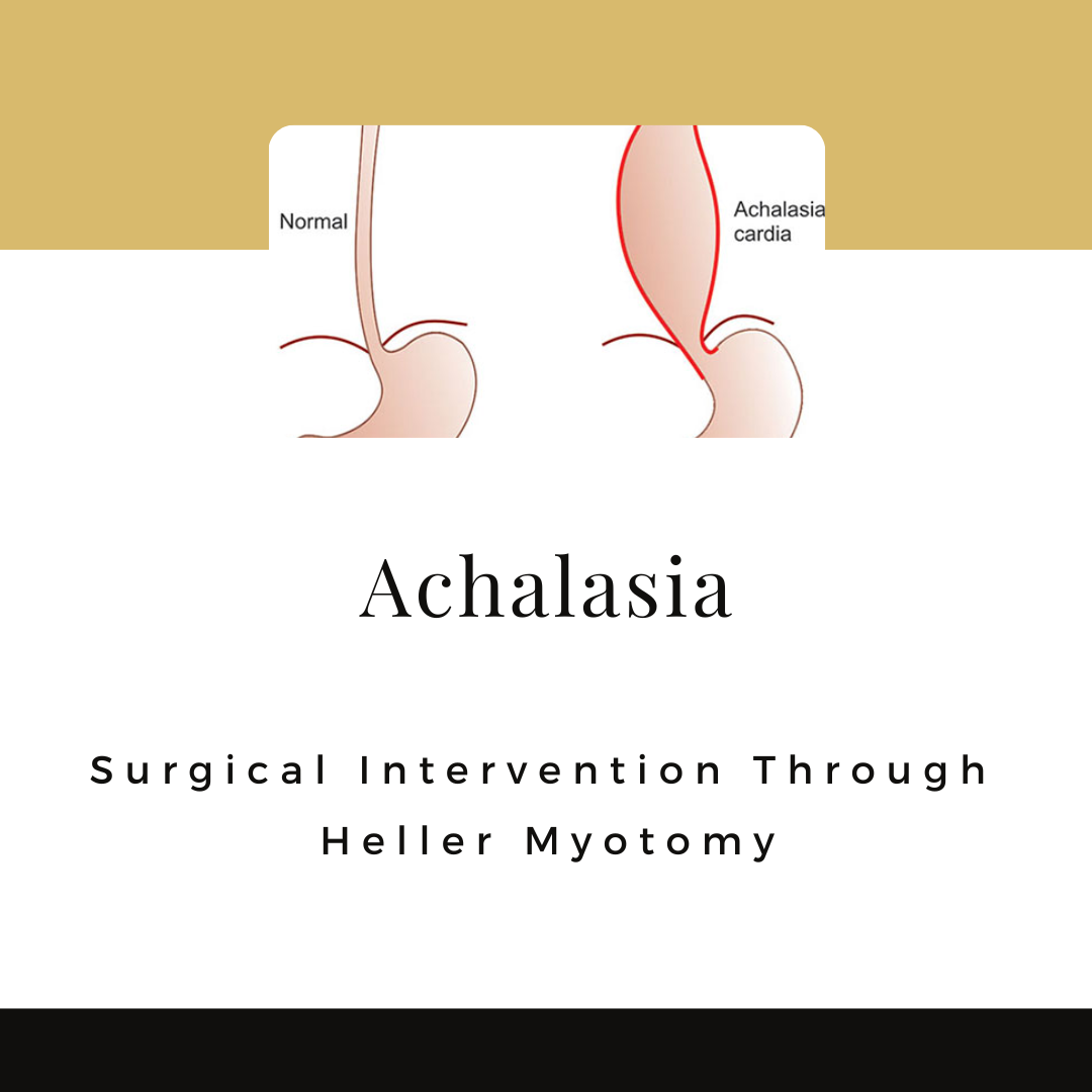 Achalasia Surgery — Advanced Management for Esophageal Motility ...