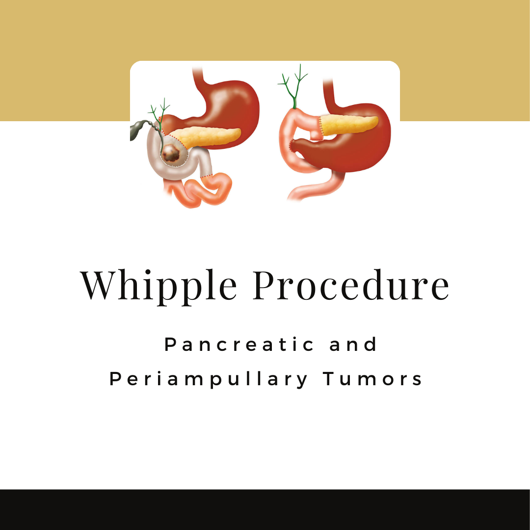 Whipple Procedure - Advanced Surgical Management for Pancreatic and ...